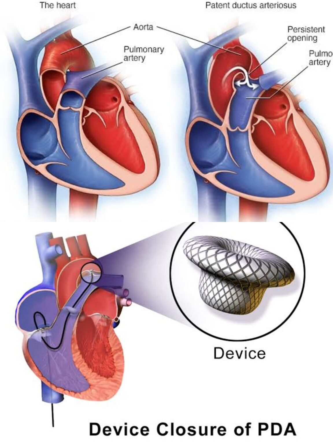 Performing device closure of Patent Ductus Arteriosus in a 9 year old ...